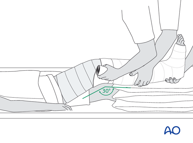 Fracture management with limited resources