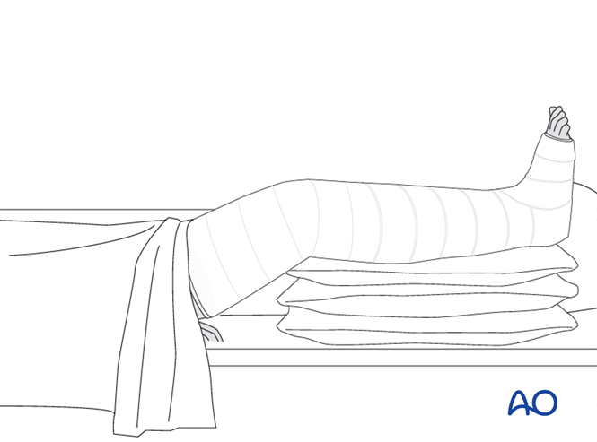 Fracture management with limited resources