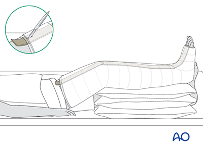 Fracture management with limited resources