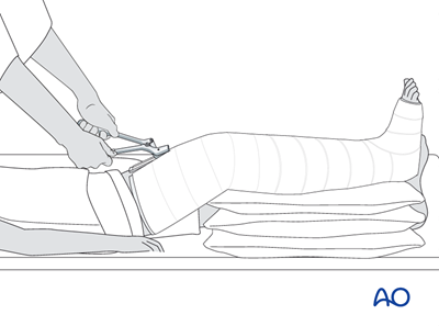 Fracture management with limited resources