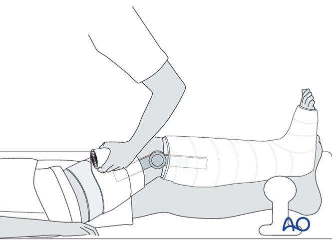 Fracture management with limited resources