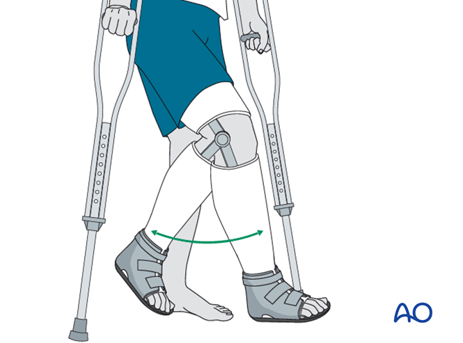 Fracture management with limited resources