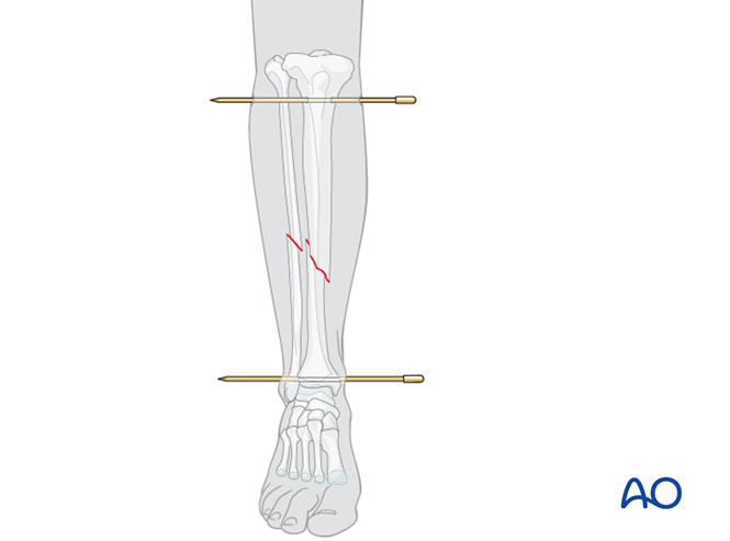 Fracture management with limited resources