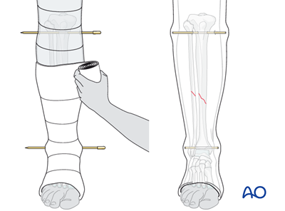 Fracture management with limited resources