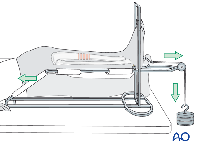 Fracture management with limited resources