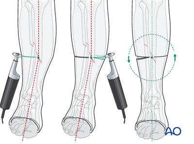 Fracture management with limited resources