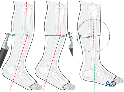 Fracture management with limited resources
