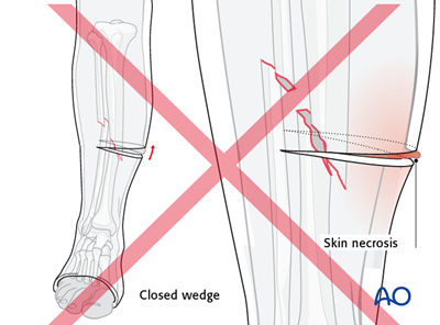 Fracture management with limited resources