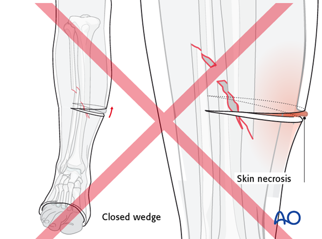 Fracture management with limited resources