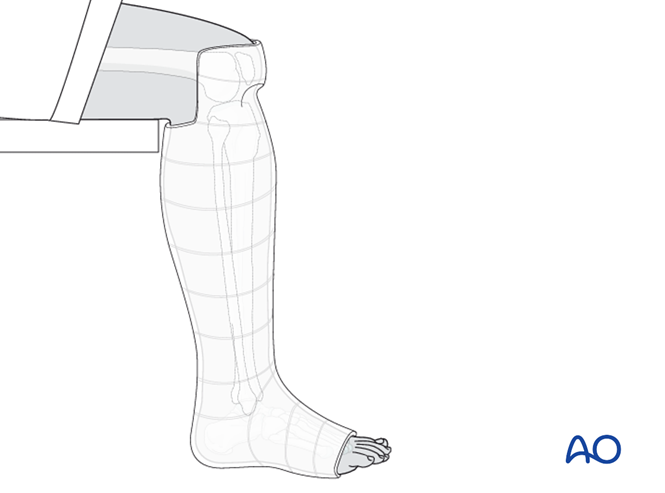 Fracture management with limited resources