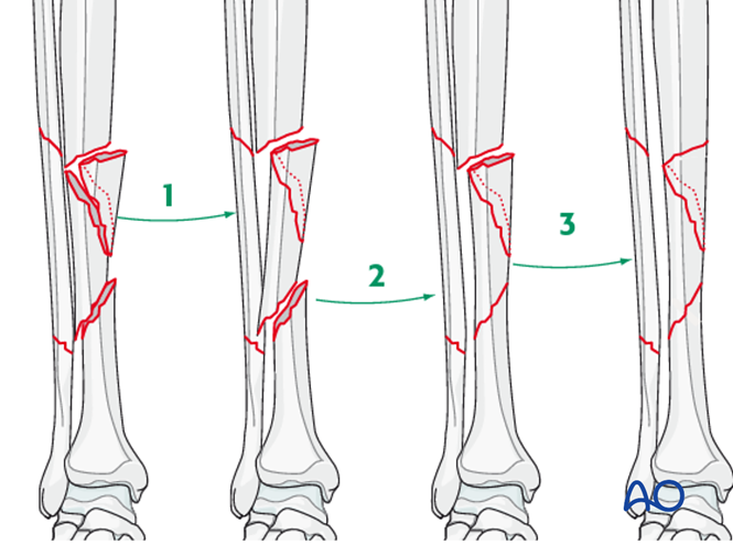 ORIF - Lag screws with protection plate for Multifragmentary fracture ...