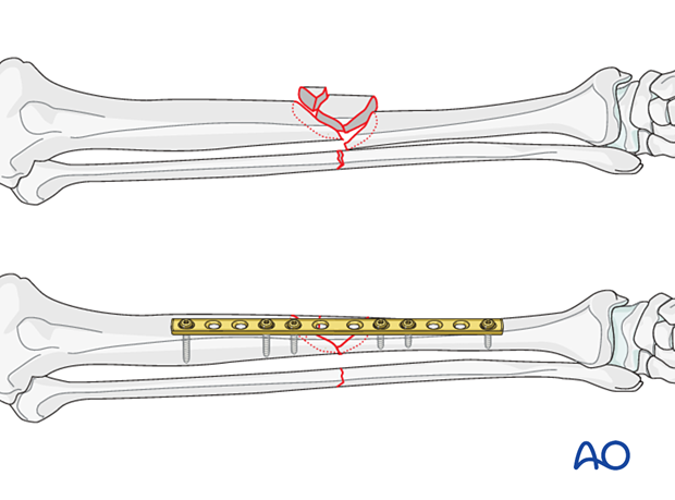Bridge plating for Wedge fracture, fragmented wedge
