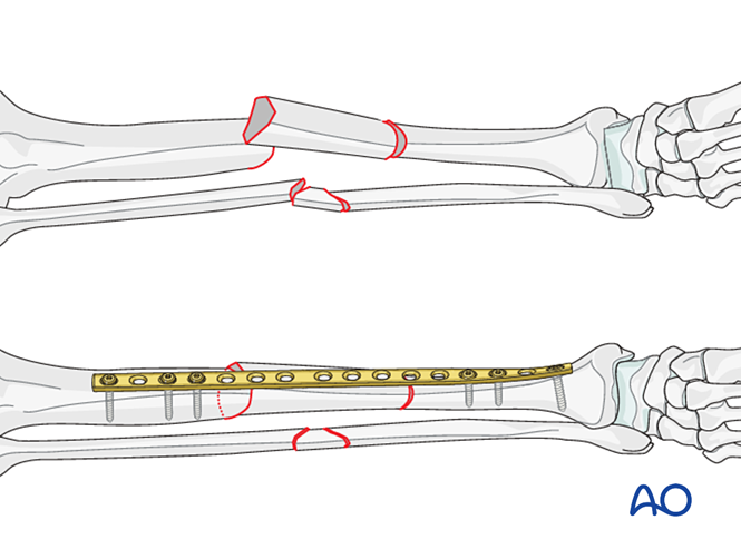 Bridge plating for Multifragmentary fracture, intact segmental