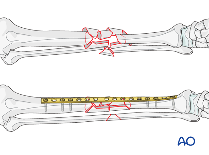 Bridge plating for Multifragmentary fracture, fragmentary segmental
