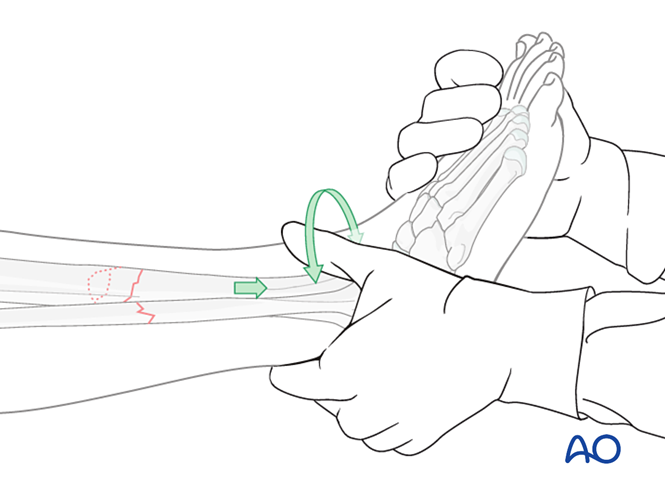 Bridge plating for Wedge fracture, fragmented wedge