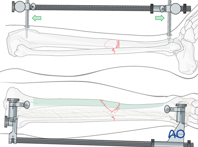 Bridge plating for Wedge fracture, intact wedge