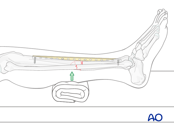 Bridge plating for Wedge fracture, fragmented wedge