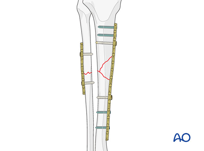Bridge plating for Wedge fracture, intact wedge