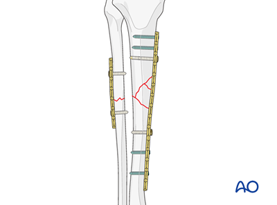 Bridge plating for Wedge fracture, fragmented wedge