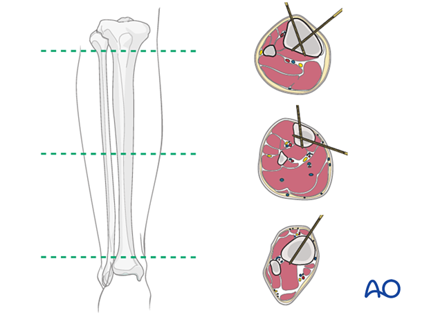Modular external fixation for Multifragmentary fracture, intact segmental