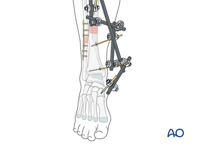 Modular external fixation for Multifragmentary fracture, fragmentary ...