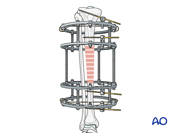 Ring fixation for Multifragmentary fracture, fragmentary segmental