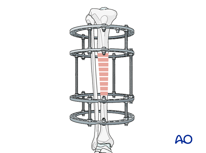 Ring fixation for Multifragmentary fracture, fragmentary segmental