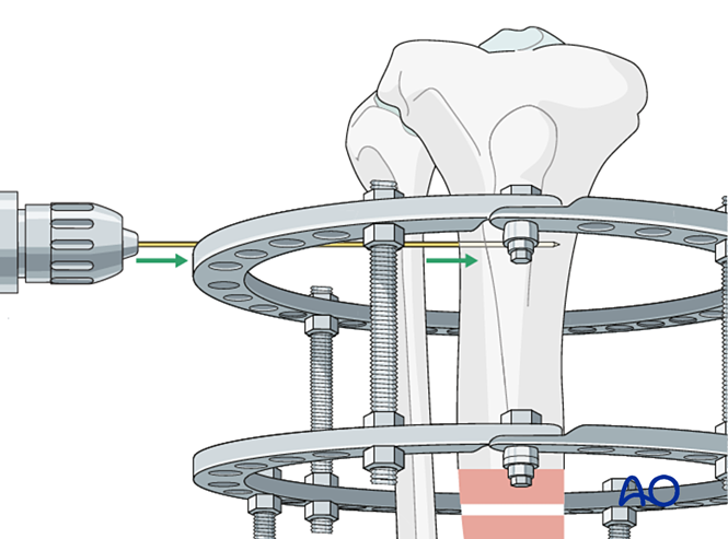 Ring fixation for Multifragmentary fracture, fragmentary segmental
