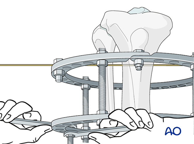 Ring fixation for Simple fracture, spiral