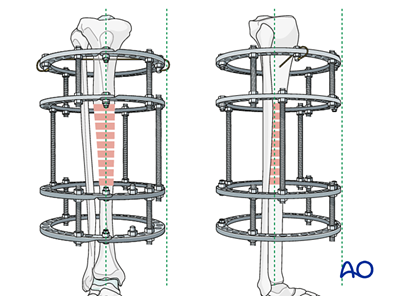 Ring fixation for Simple fracture, spiral