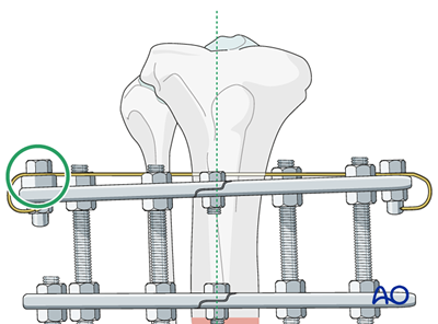Ring fixation for Multifragmentary fracture, fragmentary segmental