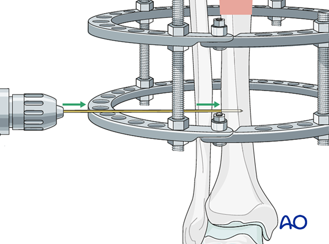 Ring fixation for Multifragmentary fracture, fragmentary segmental