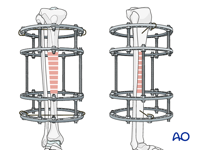 Ring fixation for Simple fracture, spiral
