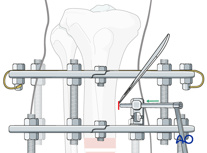 Ring fixation for Simple fracture, spiral