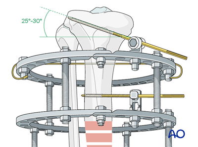 Ring fixation for Simple fracture, spiral
