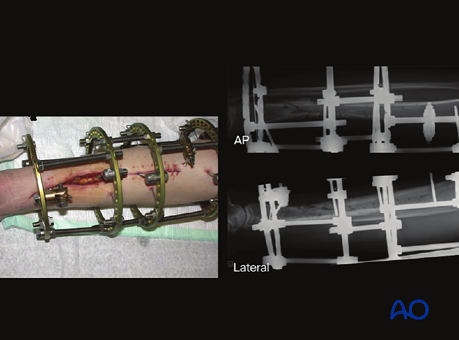 Ring fixation for Simple fracture, spiral