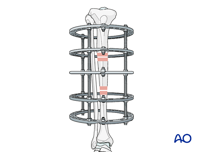 Ring fixation for Multifragmentary fracture, intact segmental