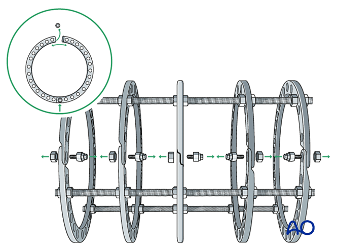 Ring fixation for Multifragmentary fracture, intact segmental