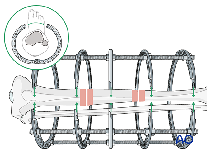 Ring fixation for Multifragmentary fracture, intact segmental