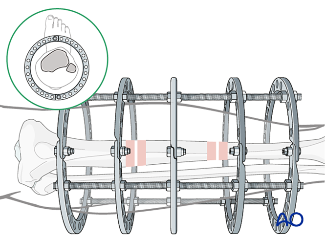 Ring fixation for Multifragmentary fracture, intact segmental