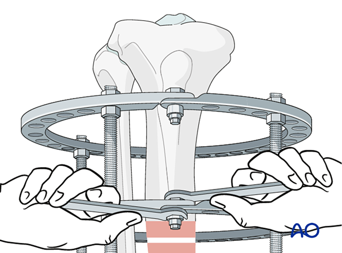 Ring fixation for Multifragmentary fracture, intact segmental