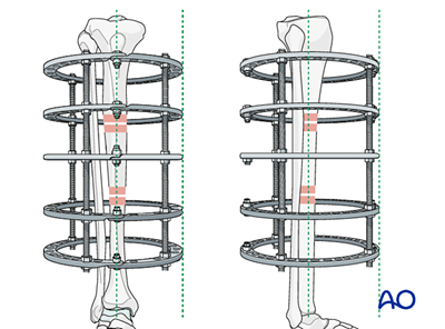 Ring fixation for Multifragmentary fracture, intact segmental
