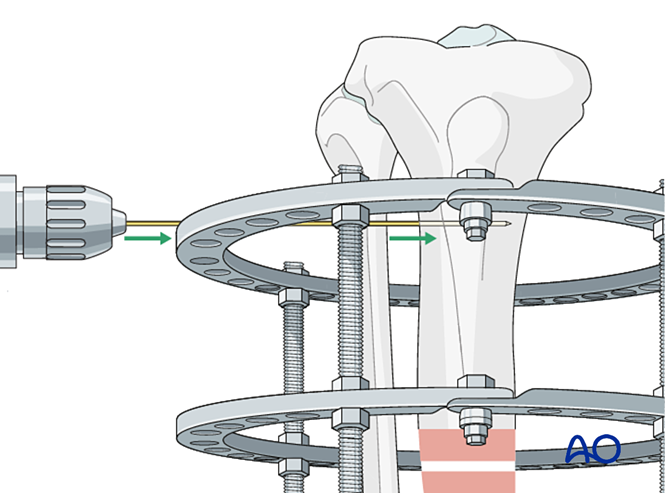 Ring fixation for Multifragmentary fracture, intact segmental