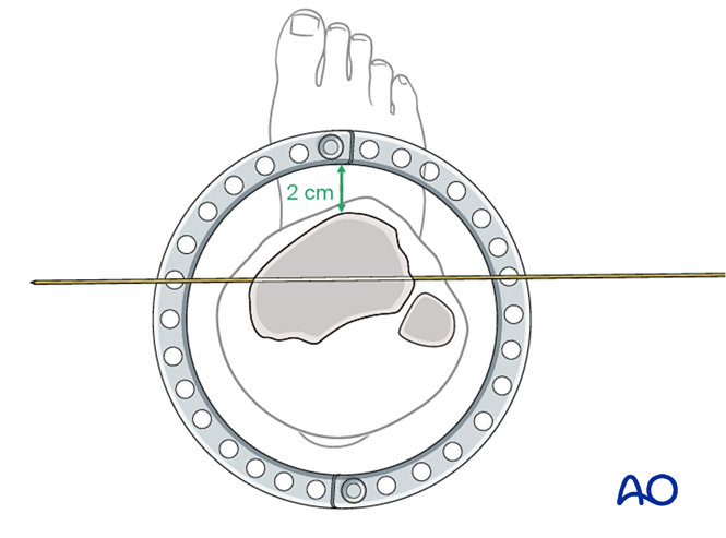 Ring fixation for Multifragmentary fracture, fragmentary segmental