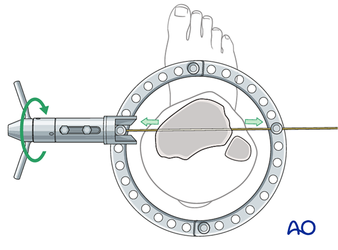 Ring fixation for Multifragmentary fracture, fragmentary segmental