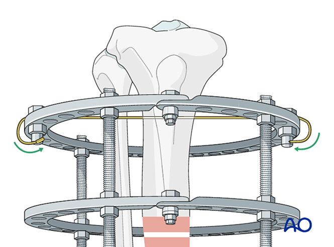 Ring fixation for Multifragmentary fracture, intact segmental