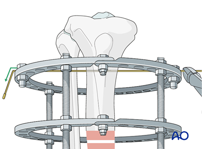 Ring fixation for Multifragmentary fracture, intact segmental