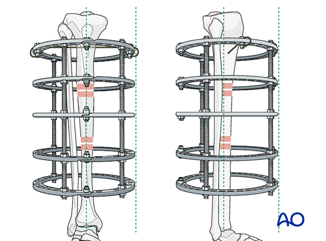 Ring fixation for Multifragmentary fracture, intact segmental