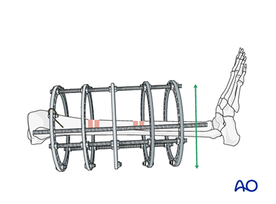 Ring fixation for Multifragmentary fracture, intact segmental