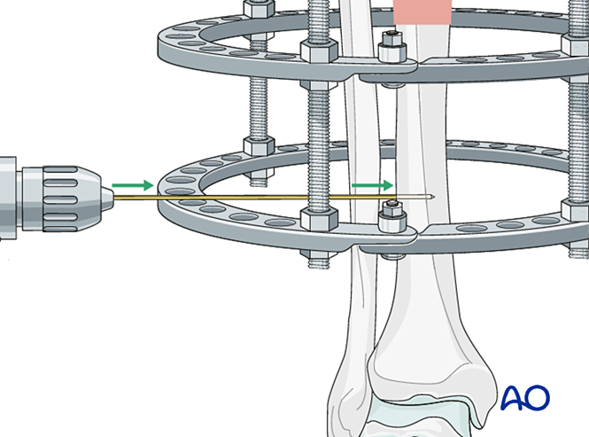 Ring fixation for Multifragmentary fracture, intact segmental
